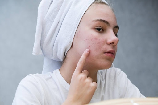 Treating Cystic Acne: What To Do and What Not To Do